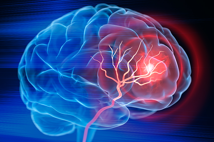Whats A Brain Aneurysm Qanda With Two Neurosurgeons Edward Elmhurst